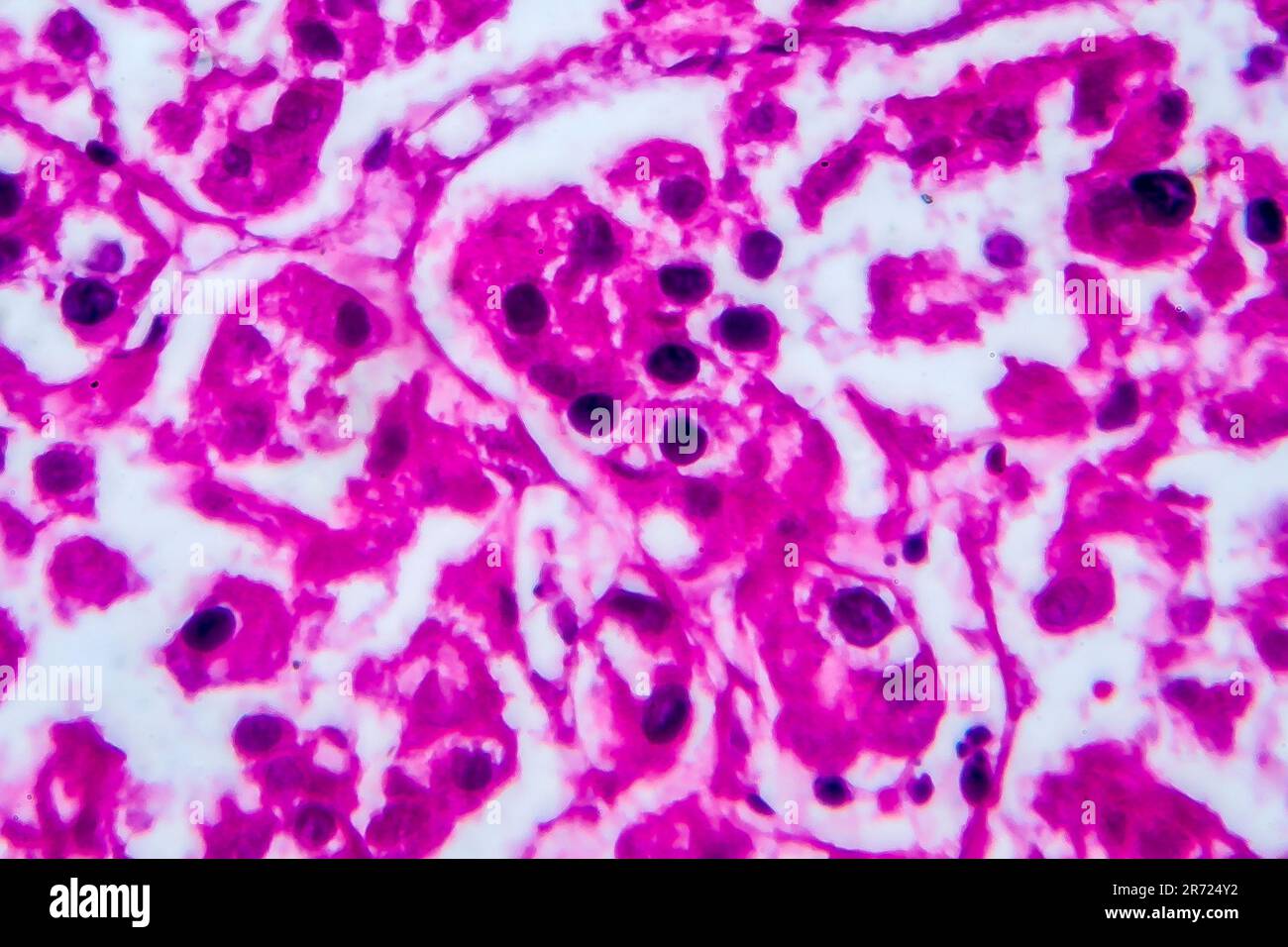 Renal cell carcinoma, light micrograph, photo under microscope. High ...