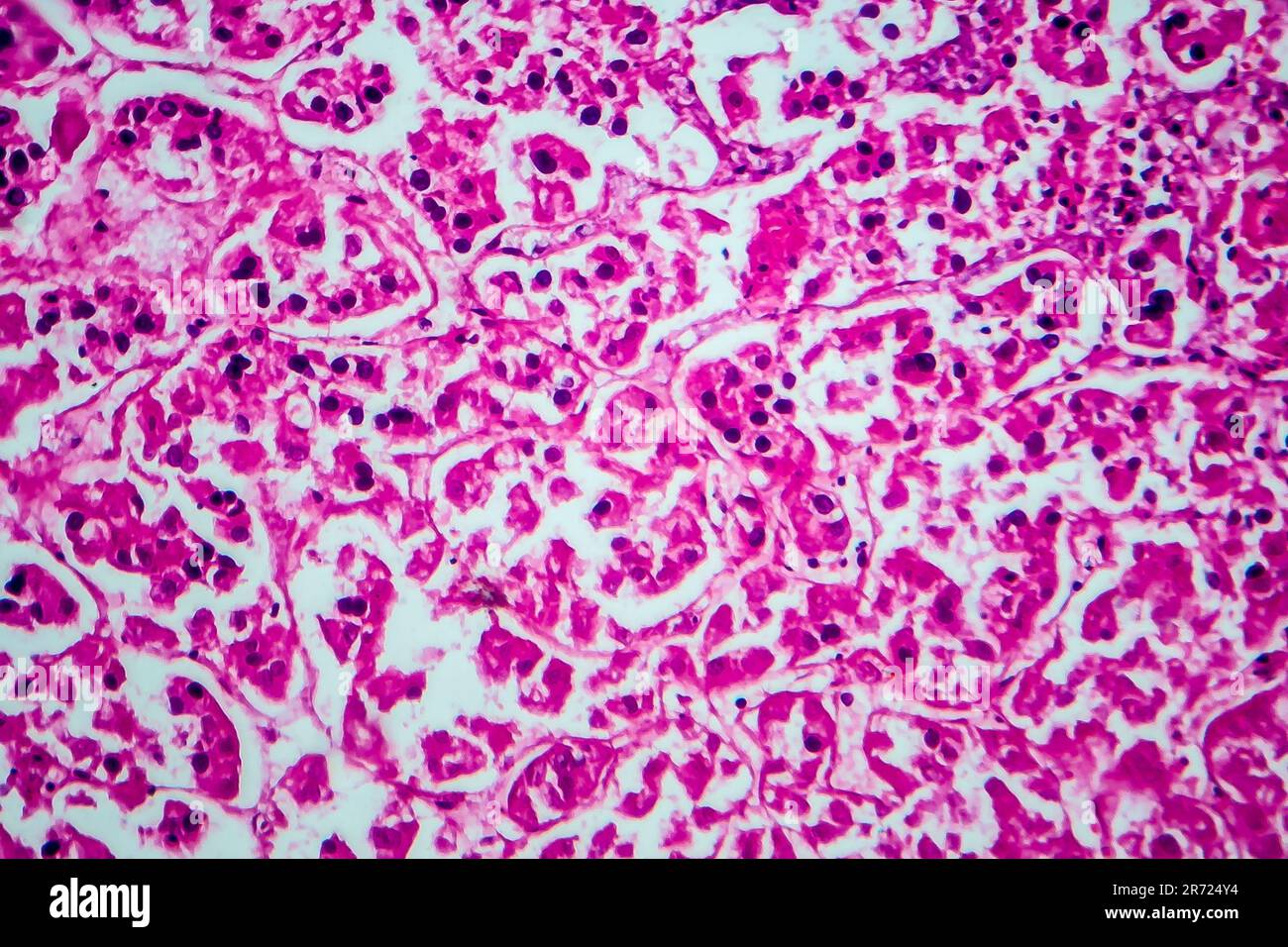 Renal cell carcinoma, light micrograph, photo under microscope Stock ...