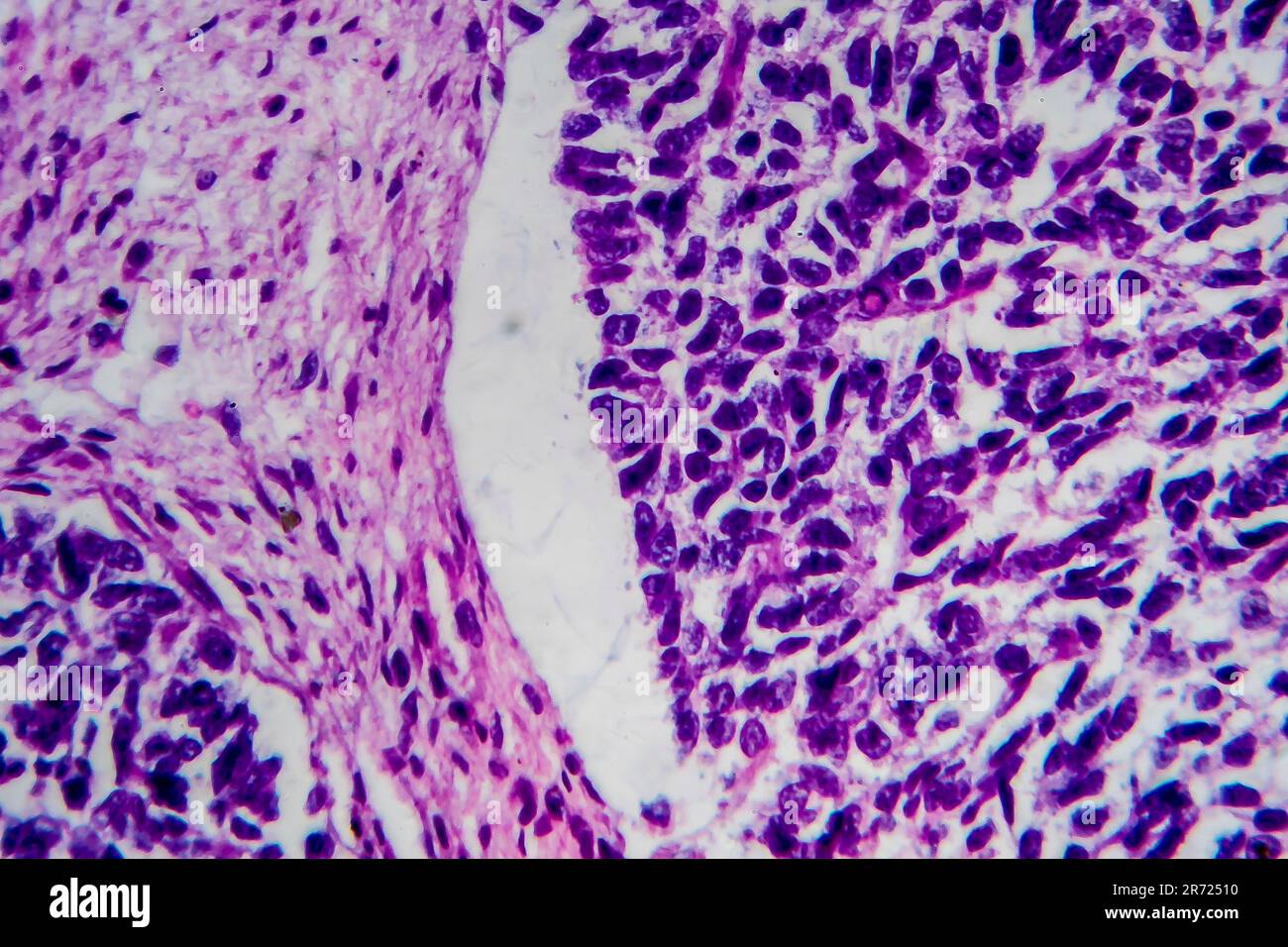 Wilms tumor, or nephroblastoma, light micrograph, photo under ...