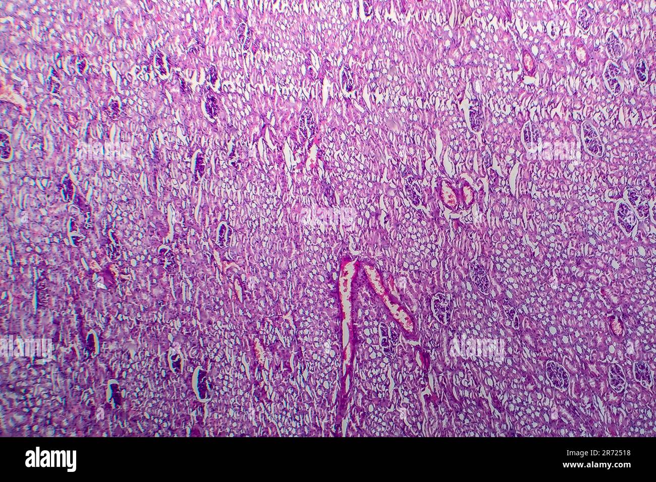 Wilms tumor, or nephroblastoma, light micrograph, photo under ...