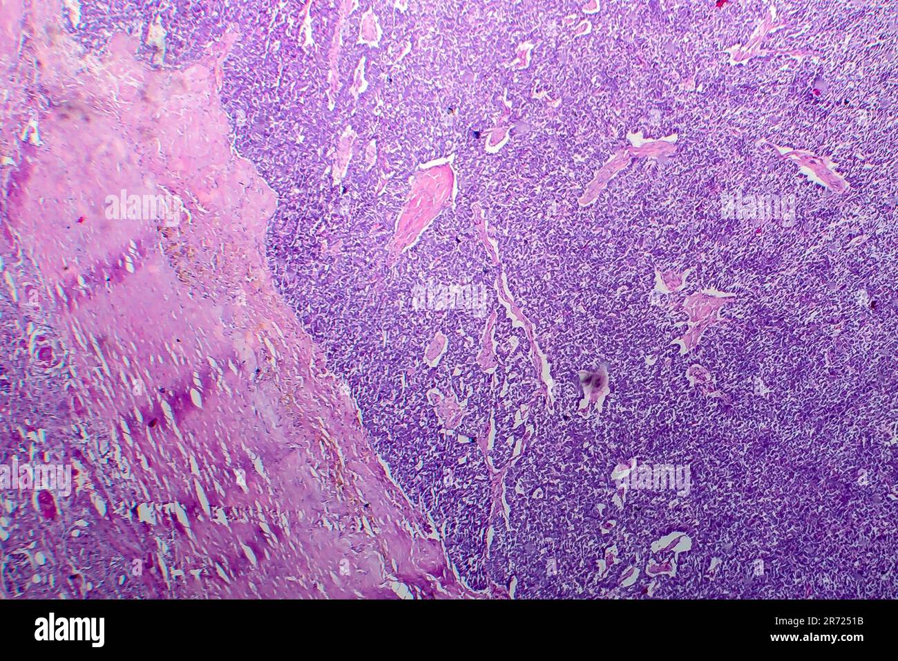Wilms tumor, or nephroblastoma, light micrograph, photo under ...