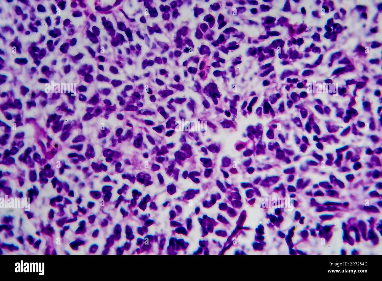 Wilms tumor, or nephroblastoma, light micrograph, photo under ...