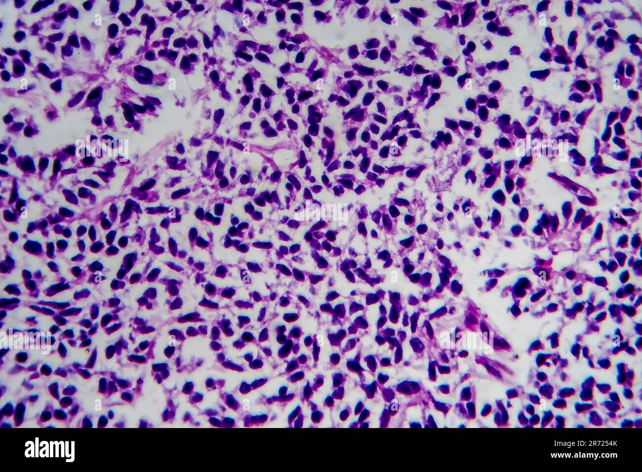 Wilms tumor, or nephroblastoma, light micrograph, photo under ...