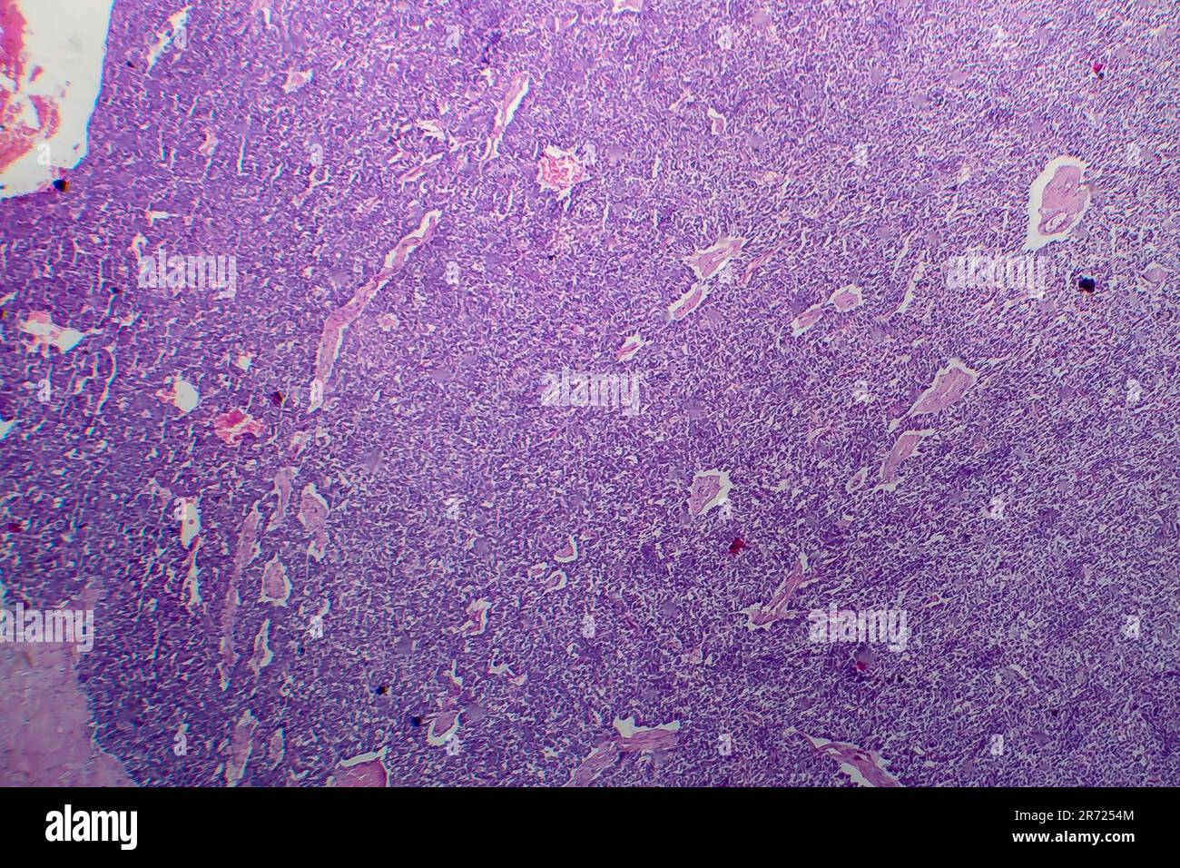 Wilms tumor, or nephroblastoma, light micrograph, photo under ...