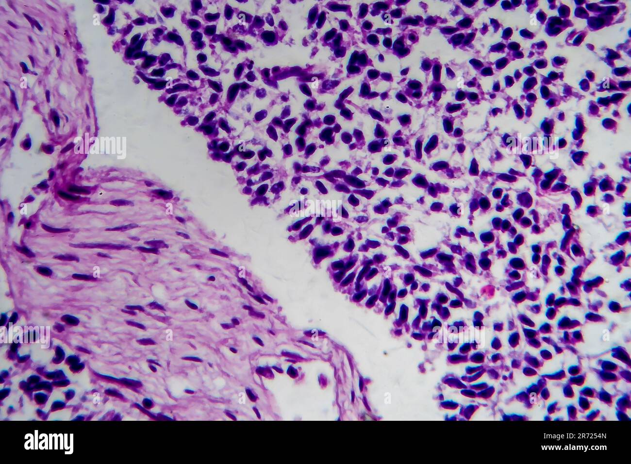 Wilms tumor, or nephroblastoma, light micrograph, photo under ...