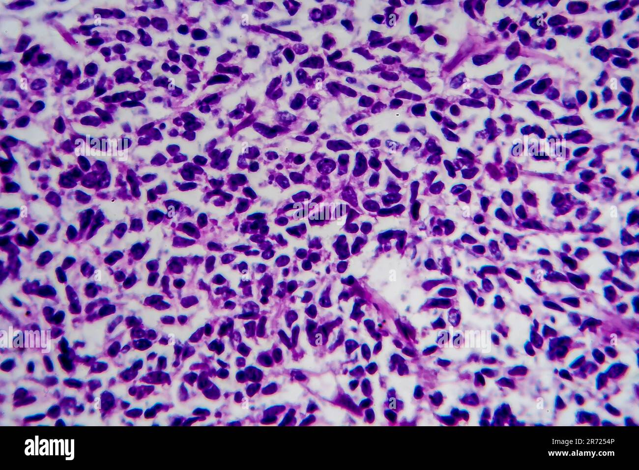 Wilms tumor, or nephroblastoma, light micrograph, photo under ...