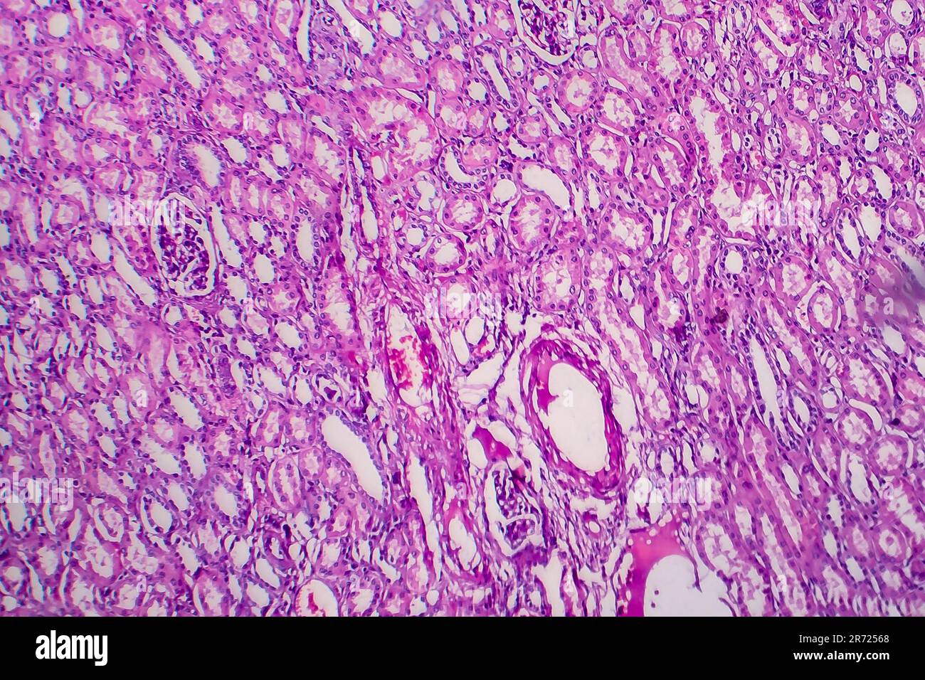 Wilms tumor, or nephroblastoma, light micrograph, photo under ...