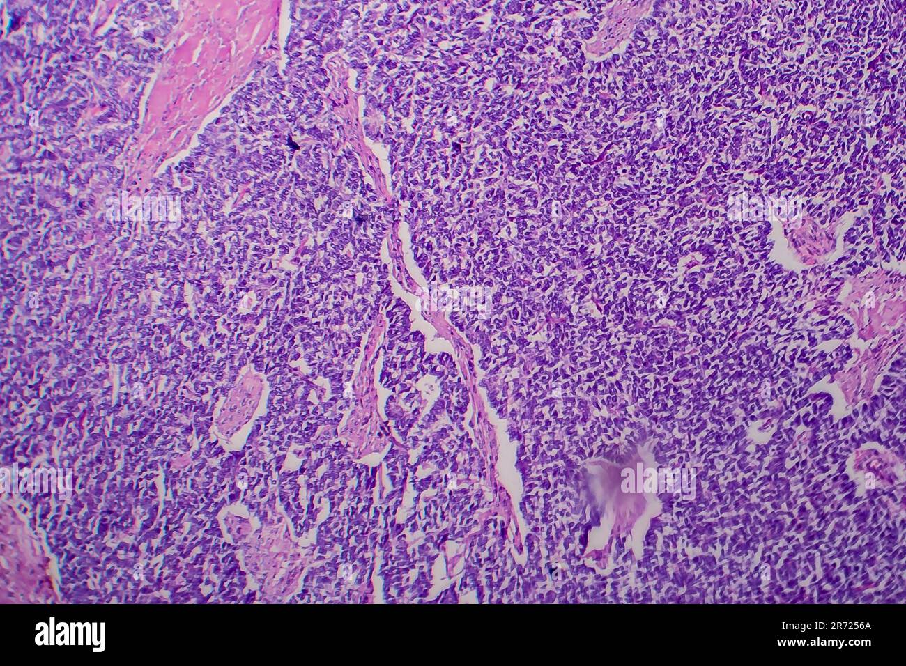 Wilms tumor, or nephroblastoma, light micrograph, photo under ...