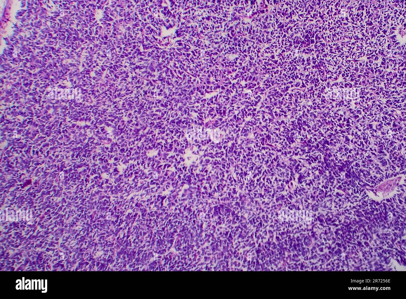 Wilms tumor, or nephroblastoma, light micrograph, photo under ...