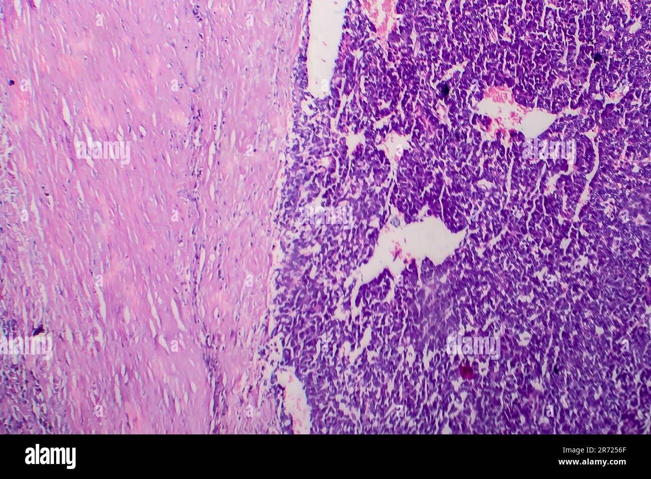 Wilms tumor, or nephroblastoma, light micrograph, photo under ...