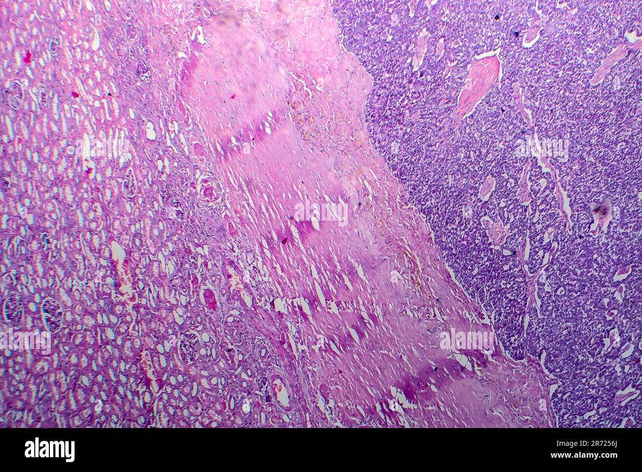 Wilms tumor, or nephroblastoma, light micrograph, photo under ...