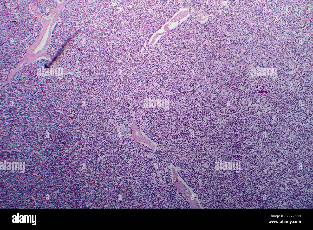 Wilms tumor, or nephroblastoma, light micrograph, photo under ...