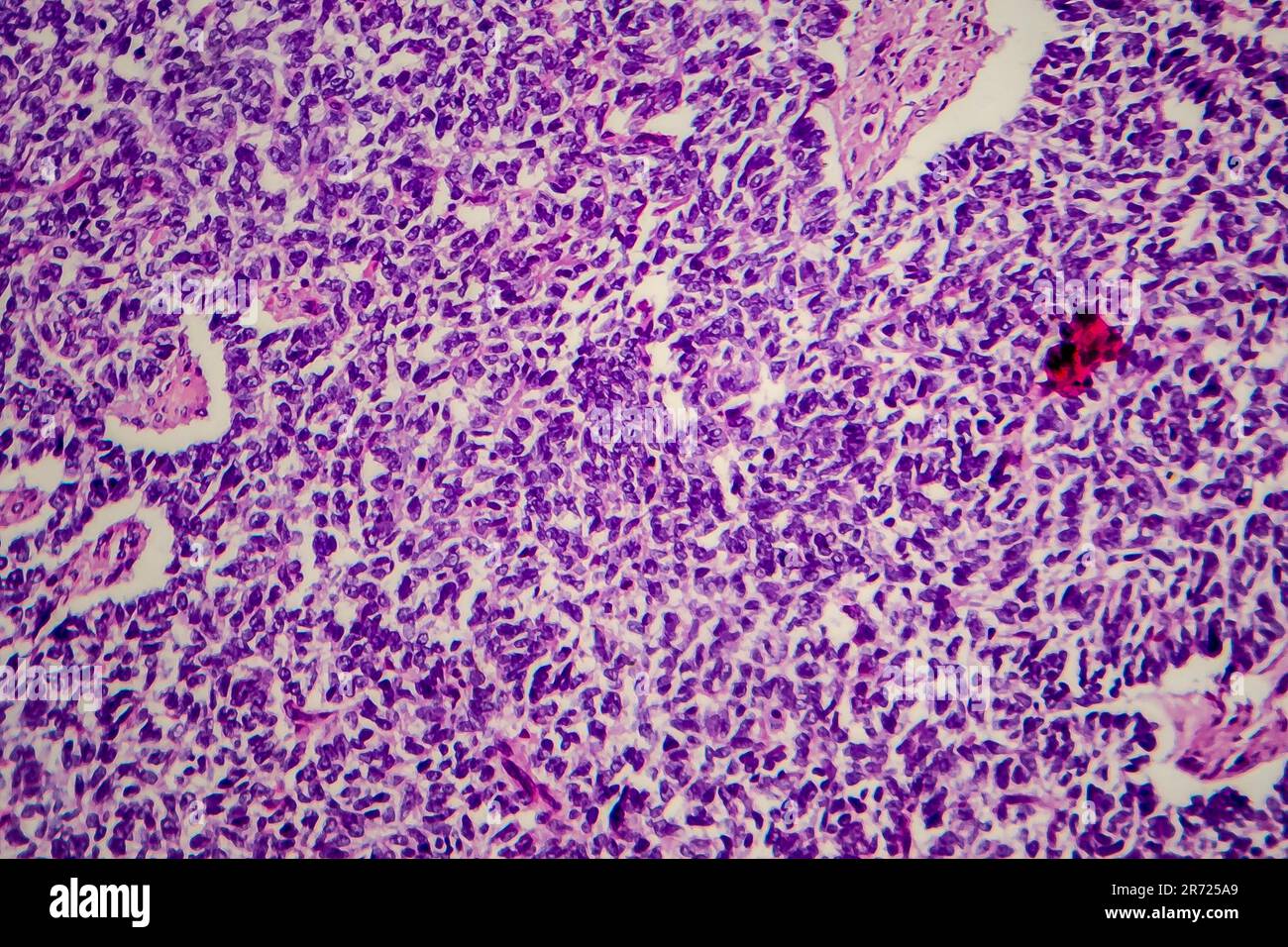 Wilms tumor, or nephroblastoma, light micrograph, photo under ...