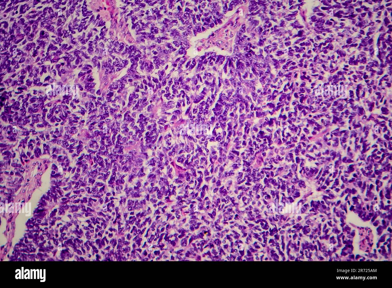 Wilms tumor, or nephroblastoma, light micrograph, photo under ...