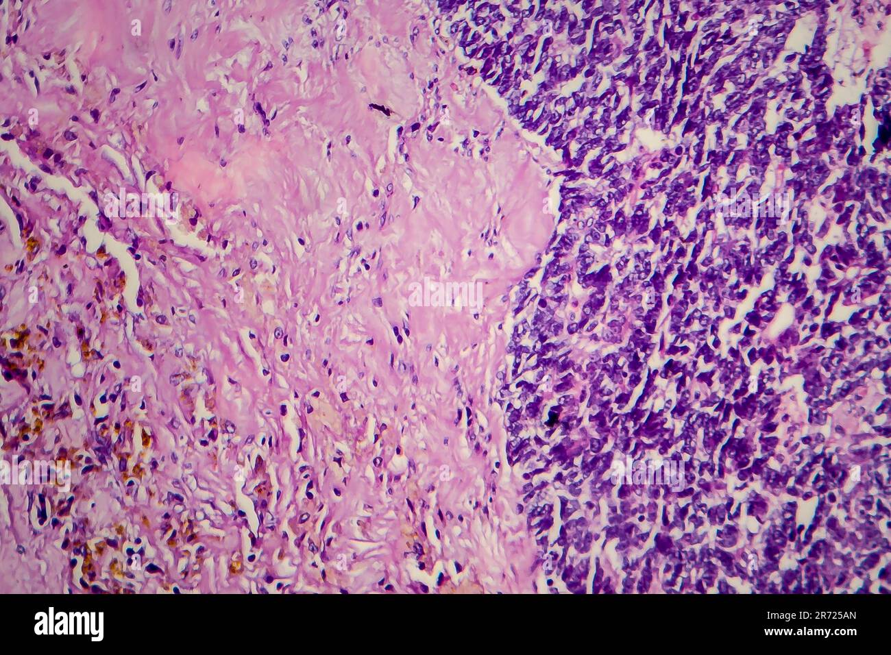 Wilms tumor, or nephroblastoma, light micrograph, photo under ...