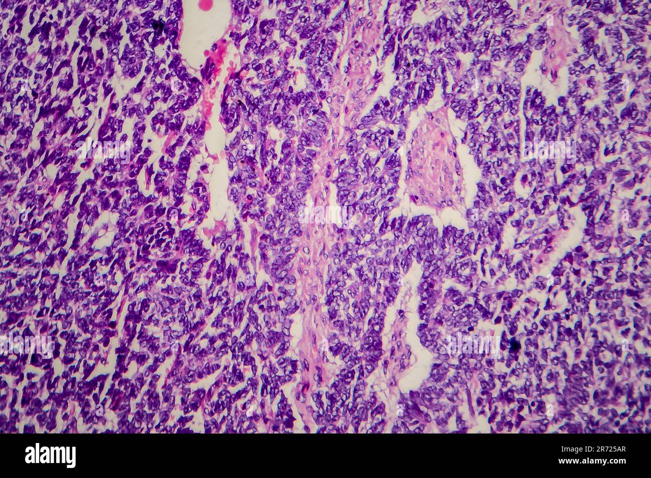 Wilms tumor, or nephroblastoma, light micrograph, photo under ...