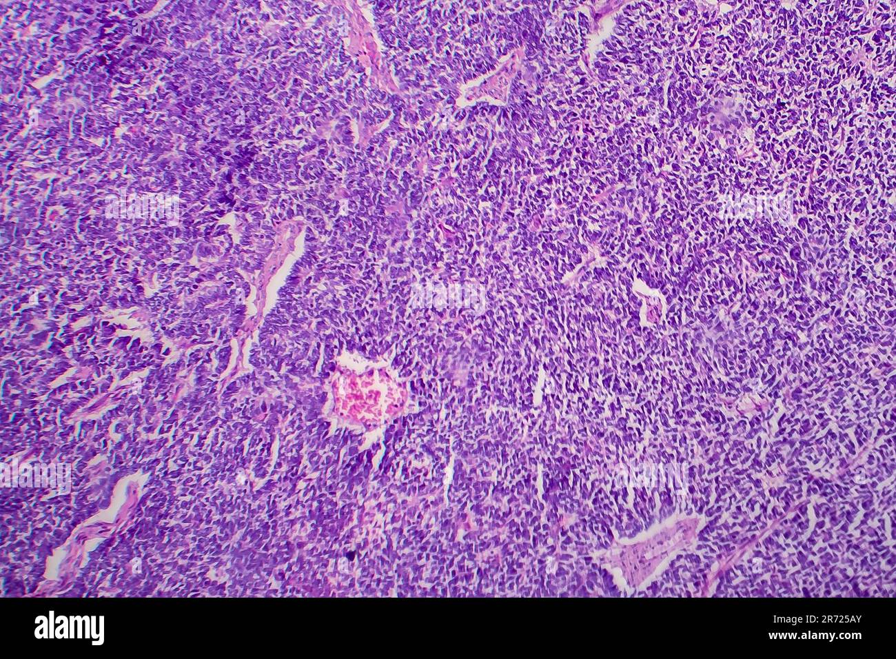 Wilms tumor, or nephroblastoma, light micrograph, photo under ...