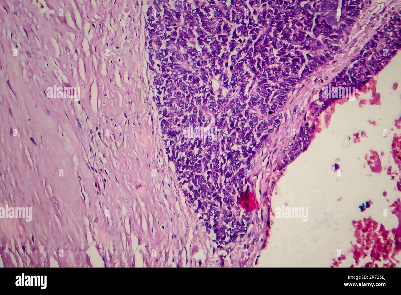 Wilms tumor, or nephroblastoma, light micrograph, photo under ...