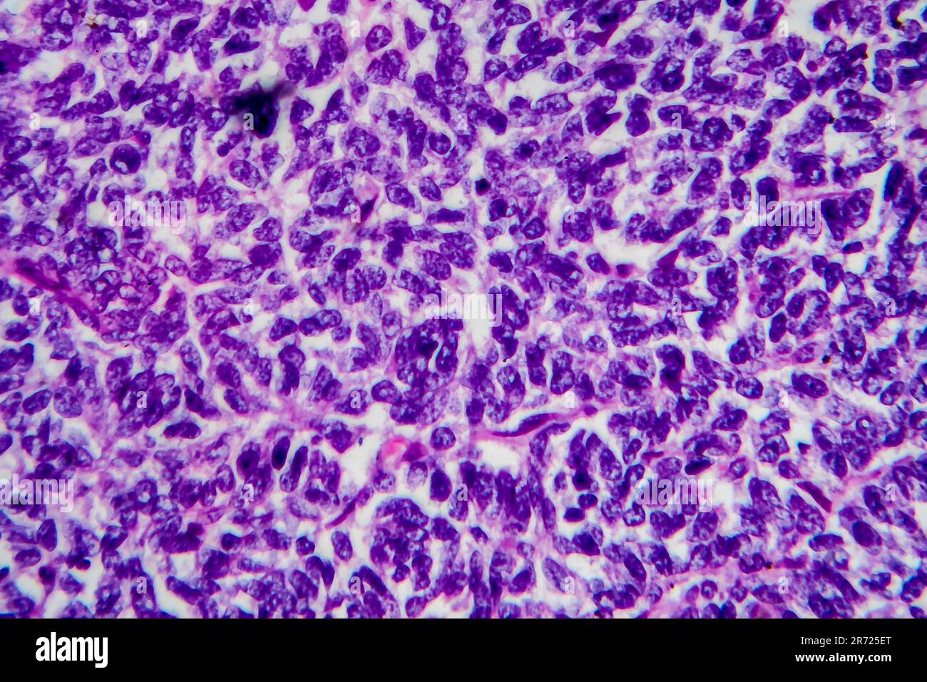 Wilms tumor, or nephroblastoma, light micrograph, photo under ...