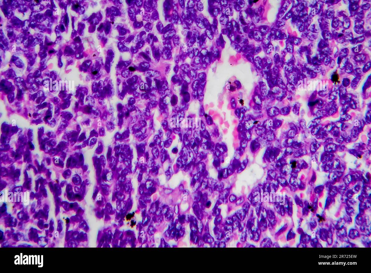 Wilms tumor, or nephroblastoma, light micrograph, photo under ...