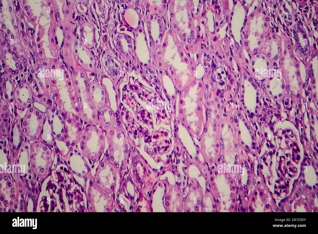 Wilms tumor, or nephroblastoma, light micrograph, photo under ...