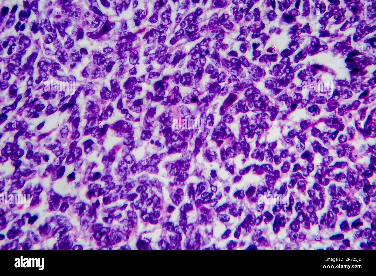 Wilms tumor, or nephroblastoma, light micrograph, photo under ...