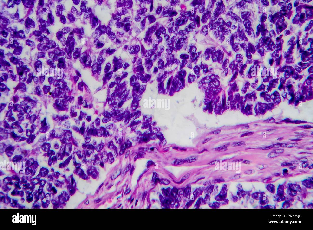 Wilms tumor, or nephroblastoma, light micrograph, photo under ...