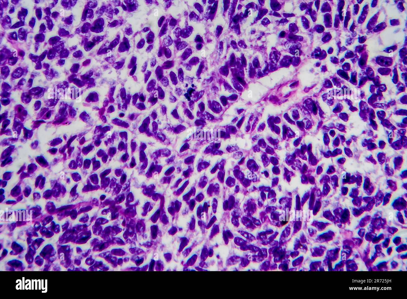 Wilms tumor, or nephroblastoma, light micrograph, photo under ...