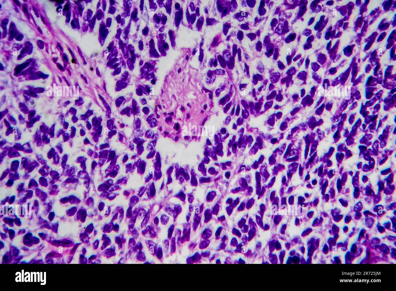 Wilms tumor, or nephroblastoma, light micrograph, photo under ...