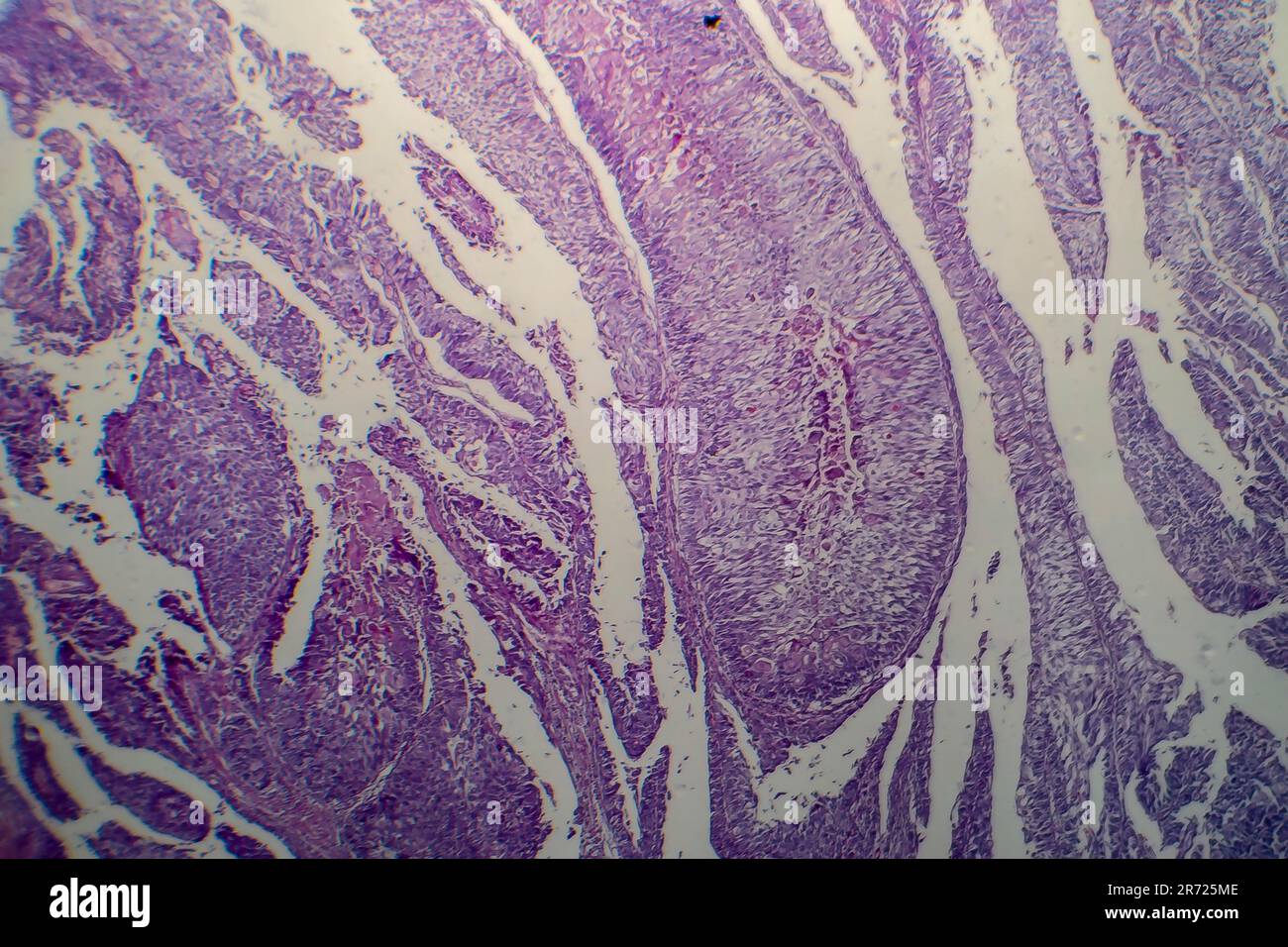 Bladder transitional cell carcinoma, light micrograph, photo under ...