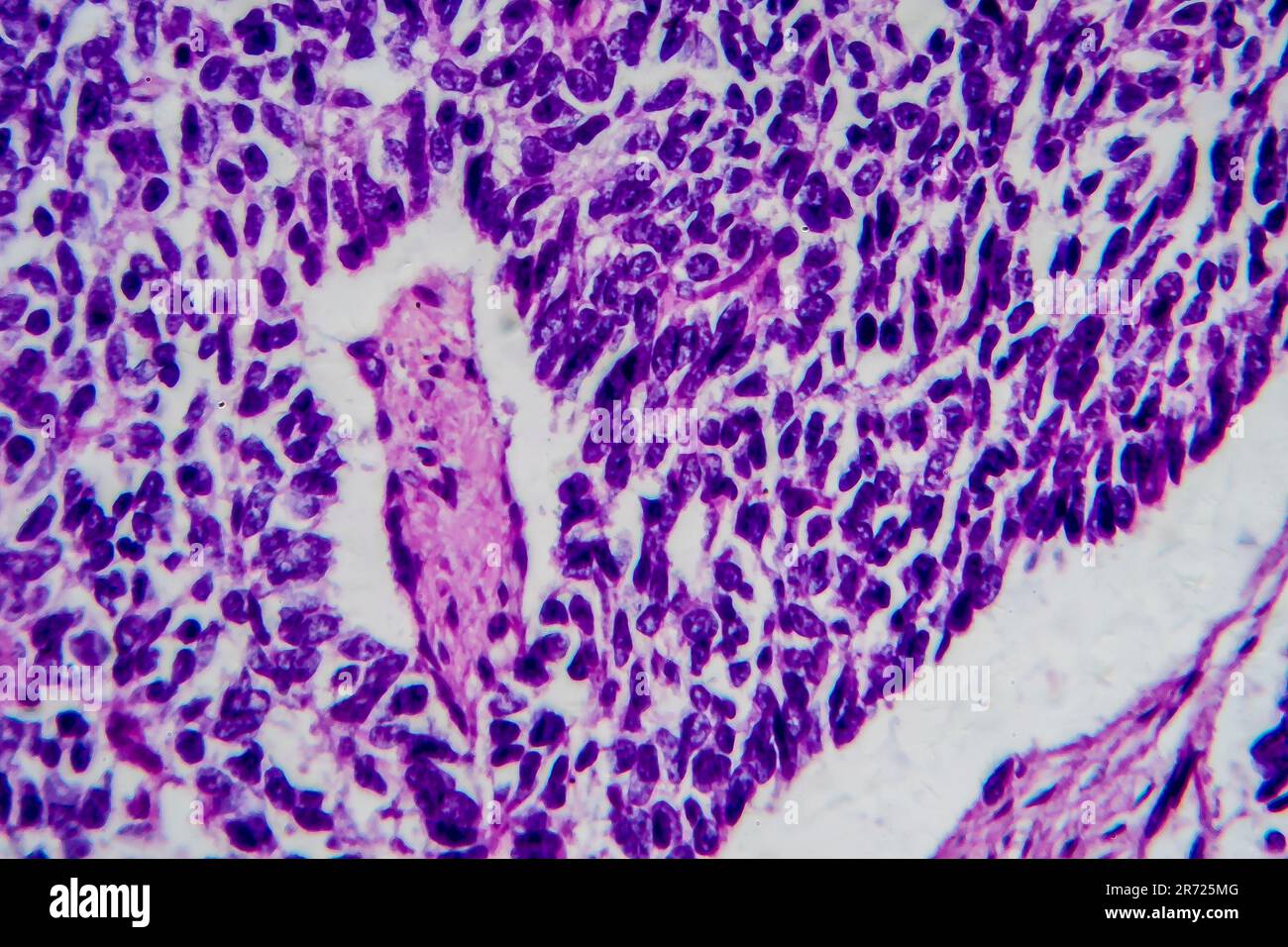 Wilms tumor, or nephroblastoma, light micrograph, photo under ...