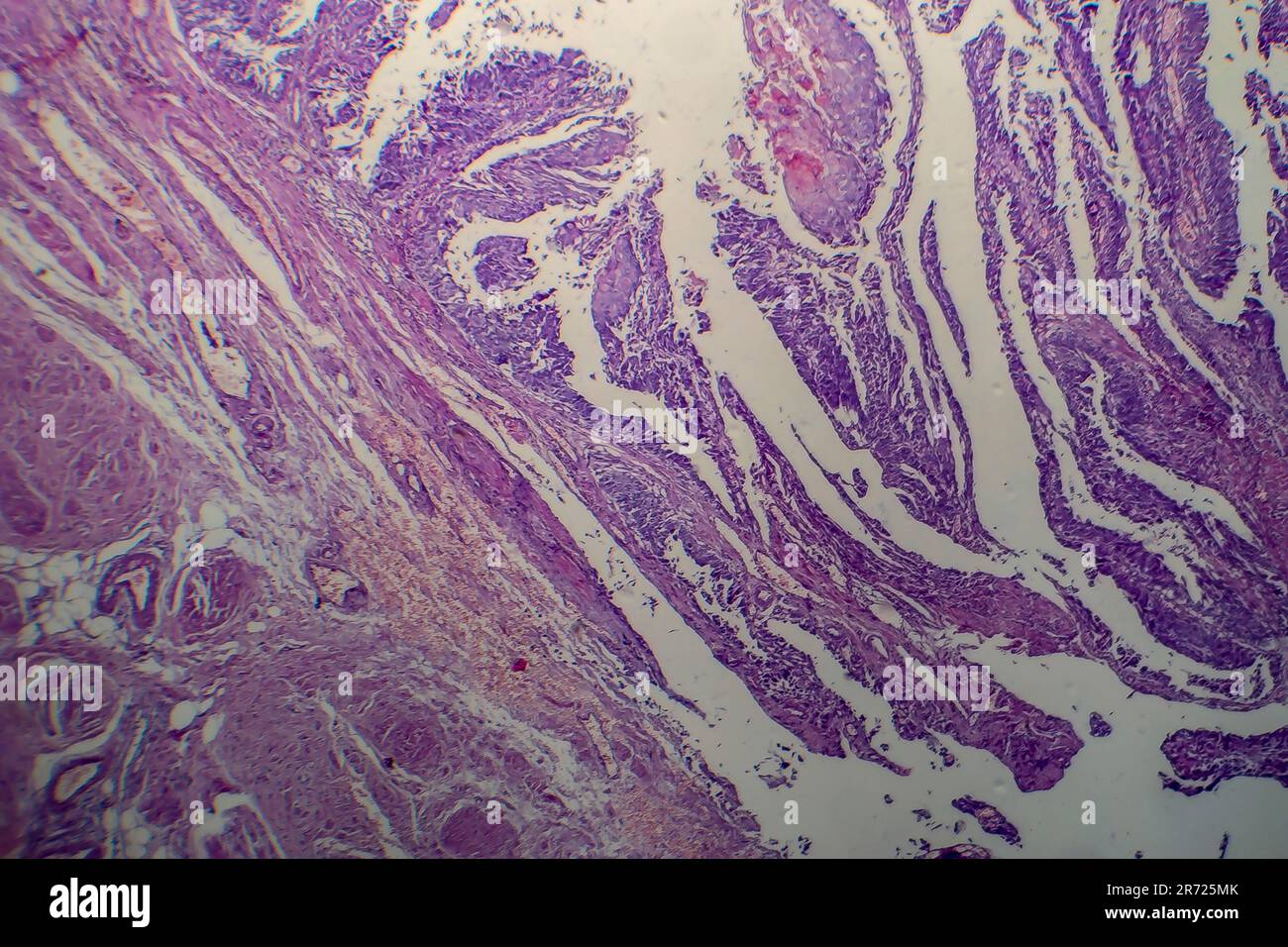 Bladder transitional cell carcinoma, light micrograph, photo under ...