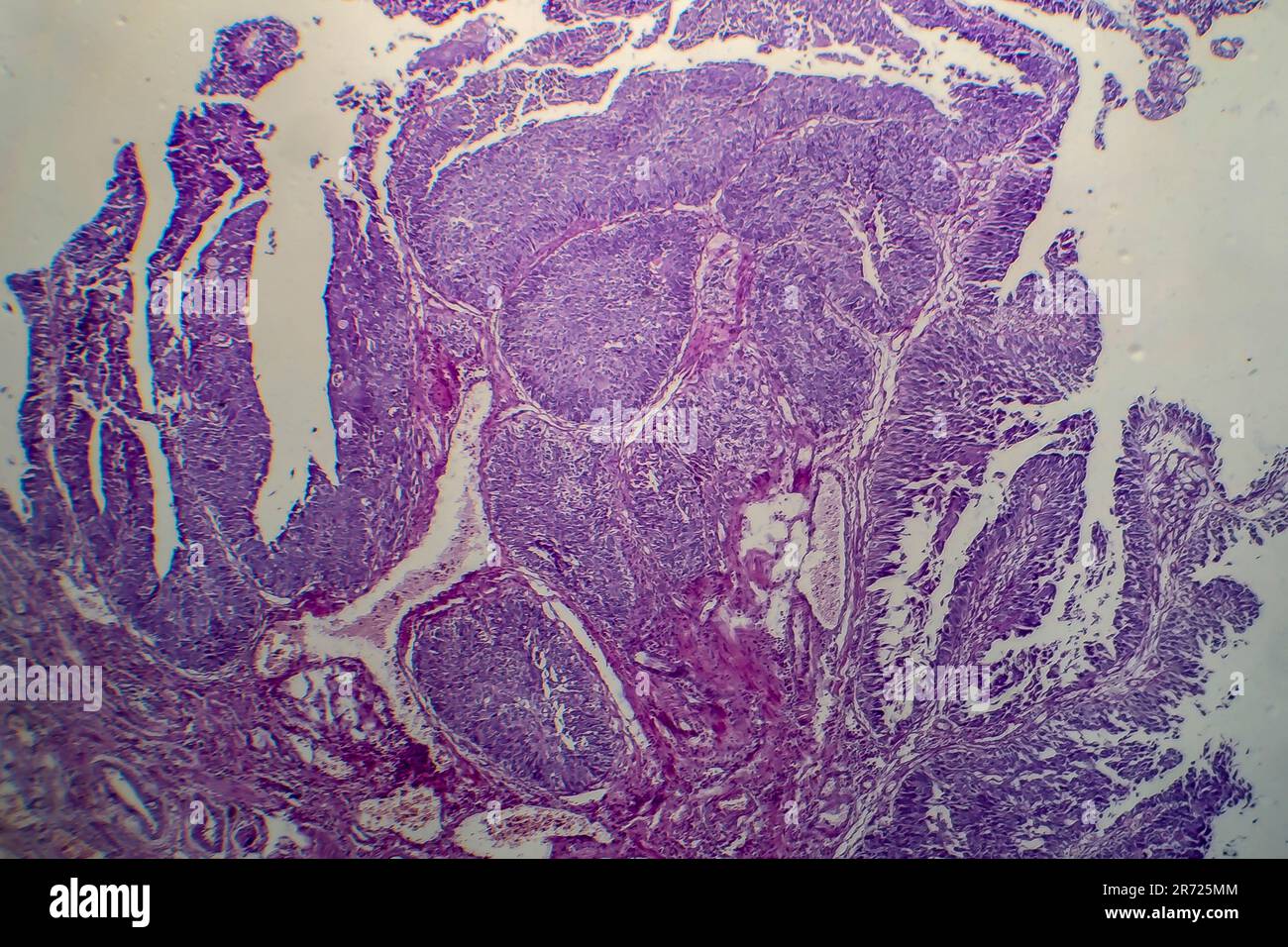 Bladder transitional cell carcinoma, light micrograph, photo under ...