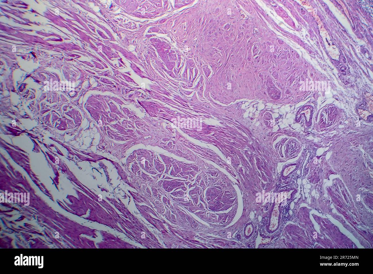Bladder transitional cell carcinoma, light micrograph, photo under ...