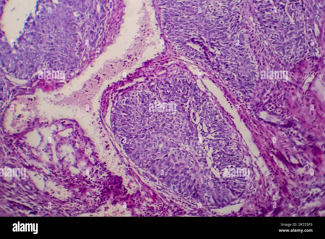 Bladder transitional cell carcinoma, light micrograph, photo under ...
