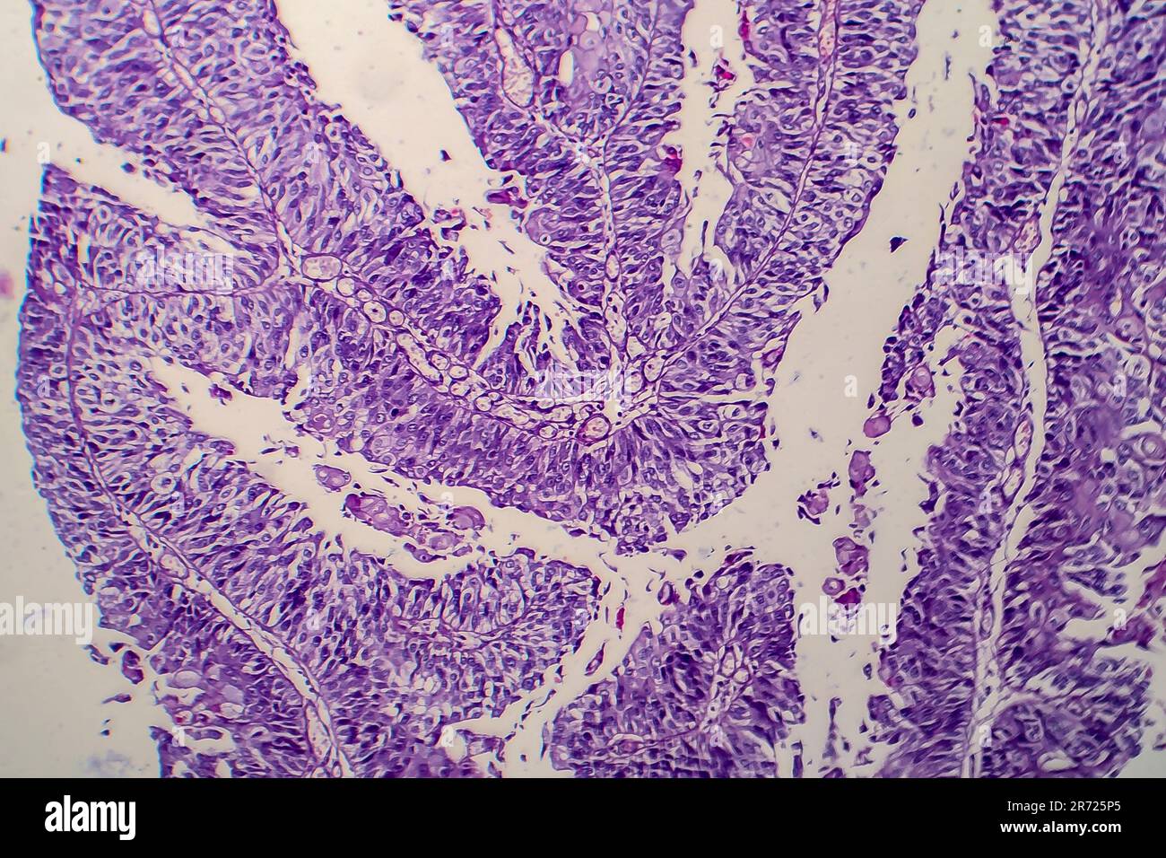 Bladder transitional cell carcinoma, light micrograph, photo under ...