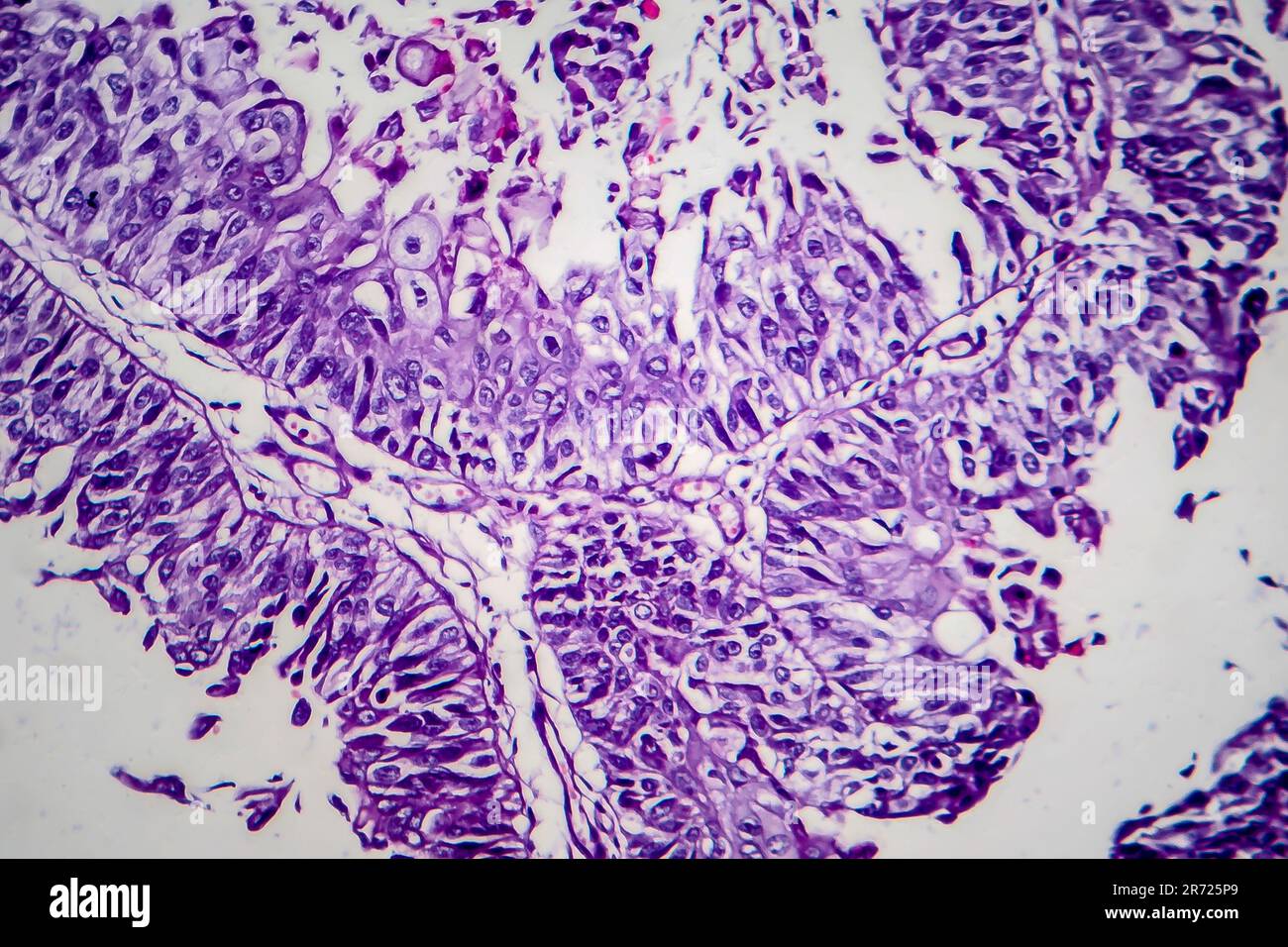 Bladder transitional cell carcinoma, light micrograph, photo under ...