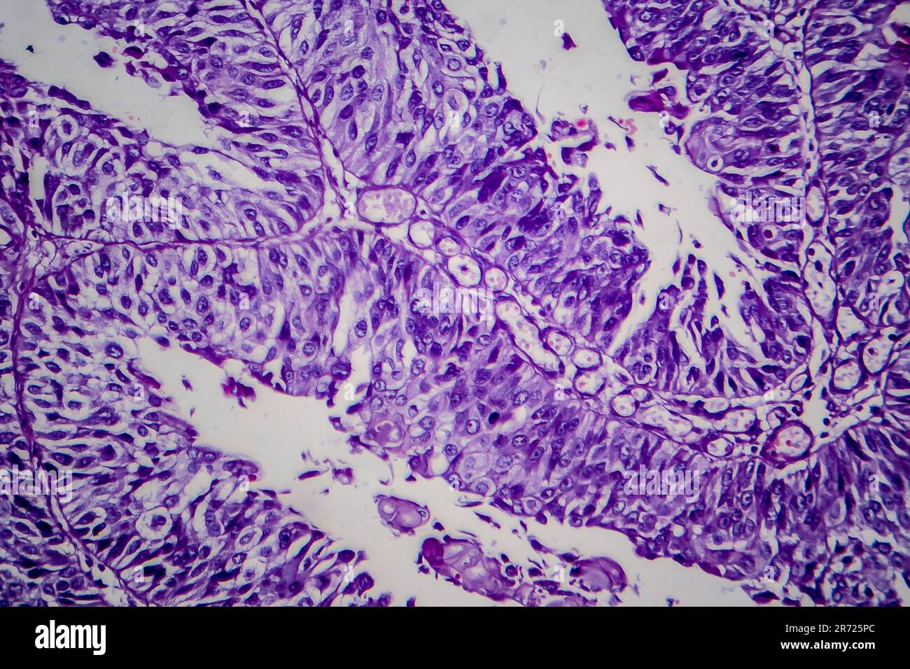 Bladder transitional cell carcinoma, light micrograph, photo under ...