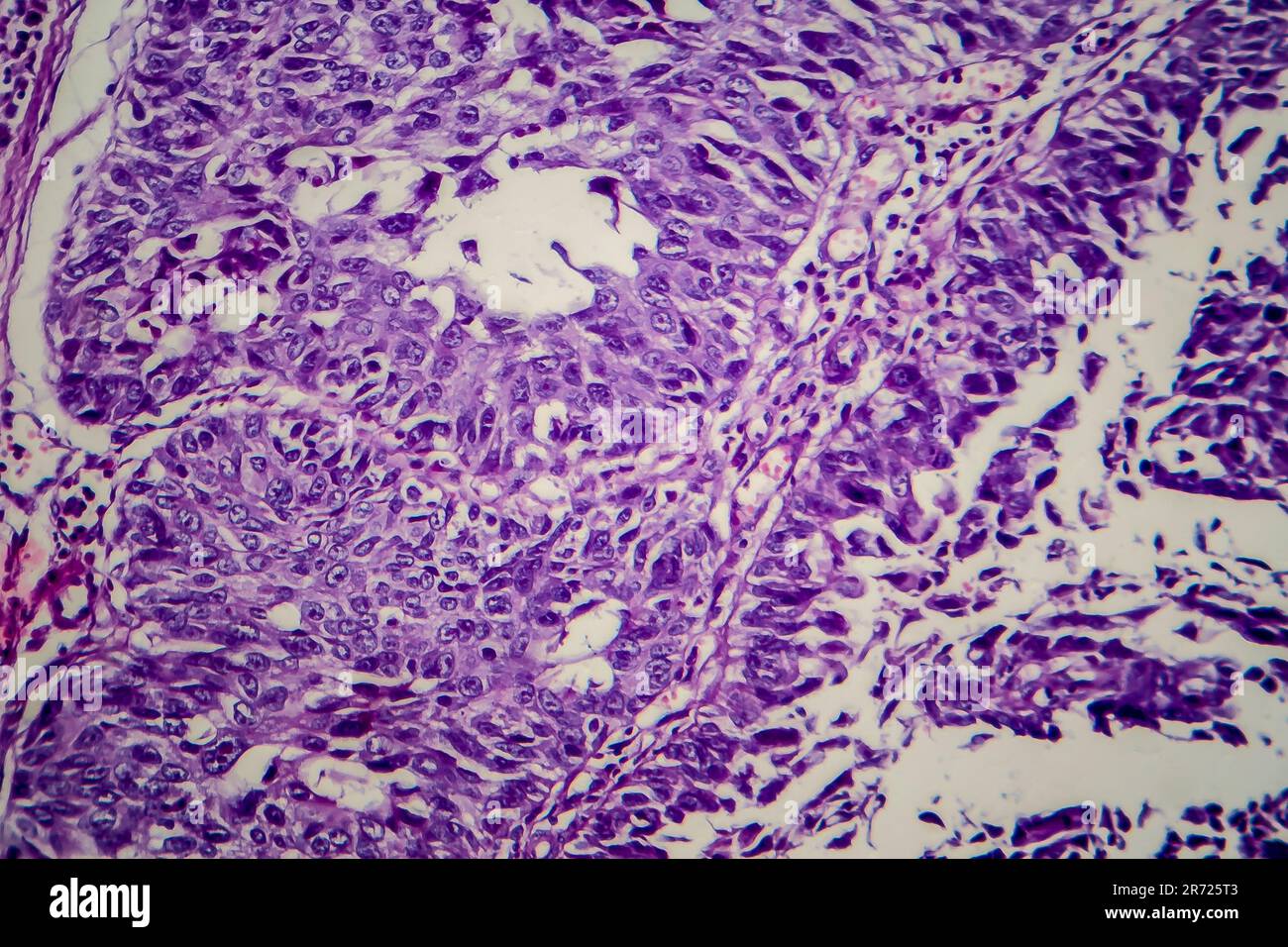 Transitional Cell Carcinoma