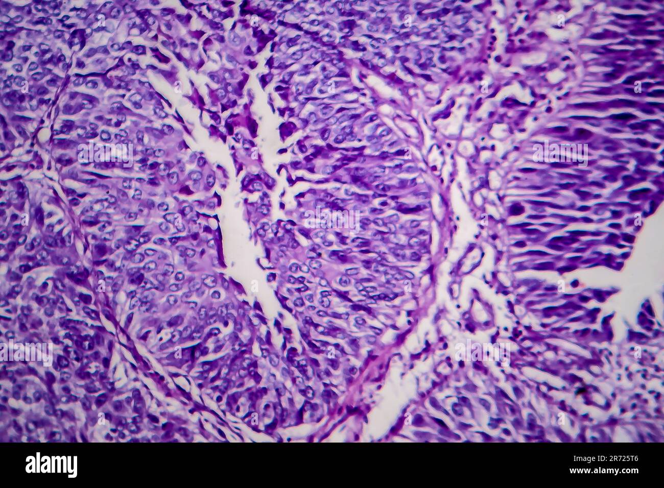 Bladder transitional cell carcinoma, light micrograph, photo under ...