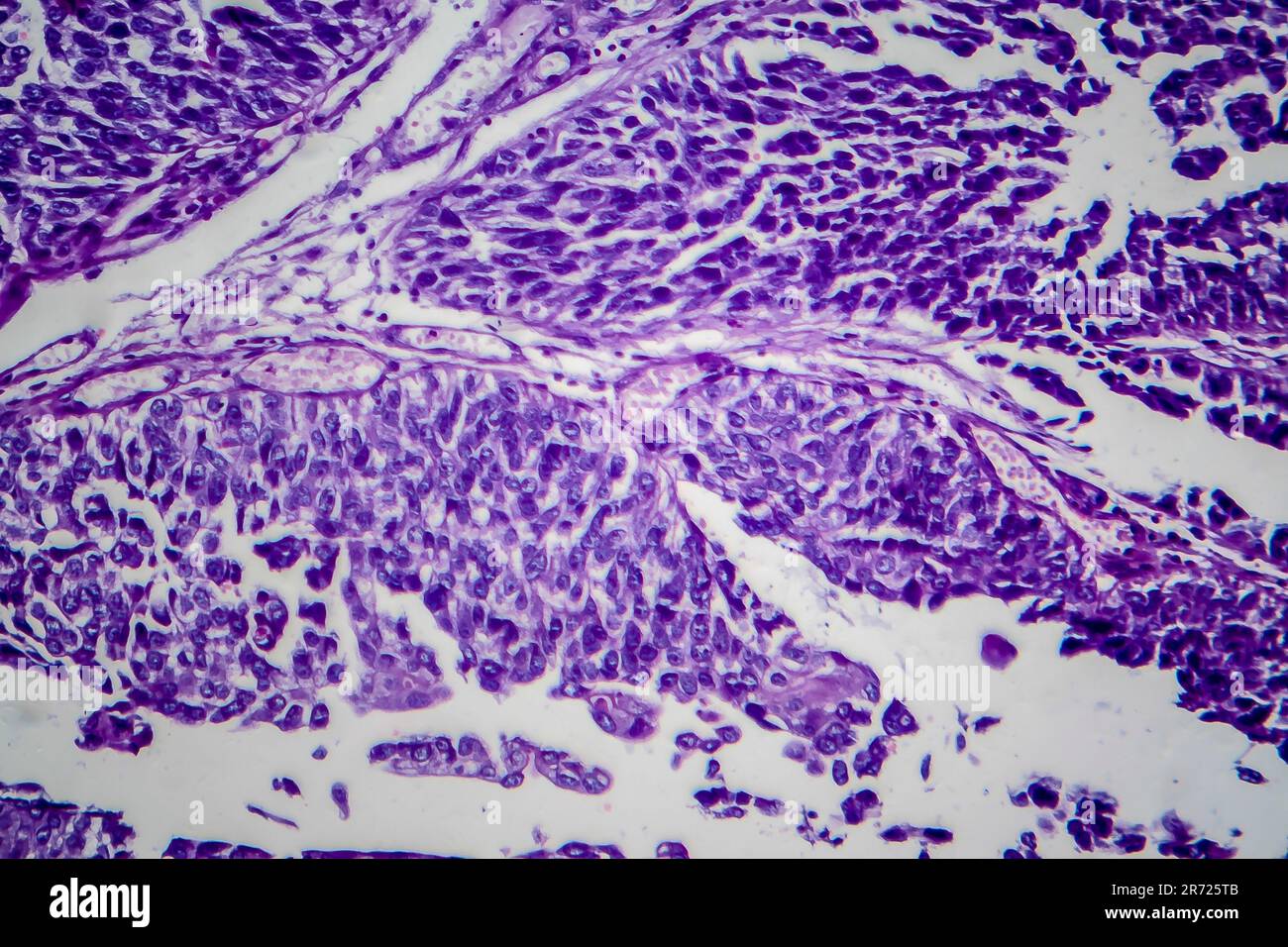 Bladder transitional cell carcinoma, light micrograph, photo under ...