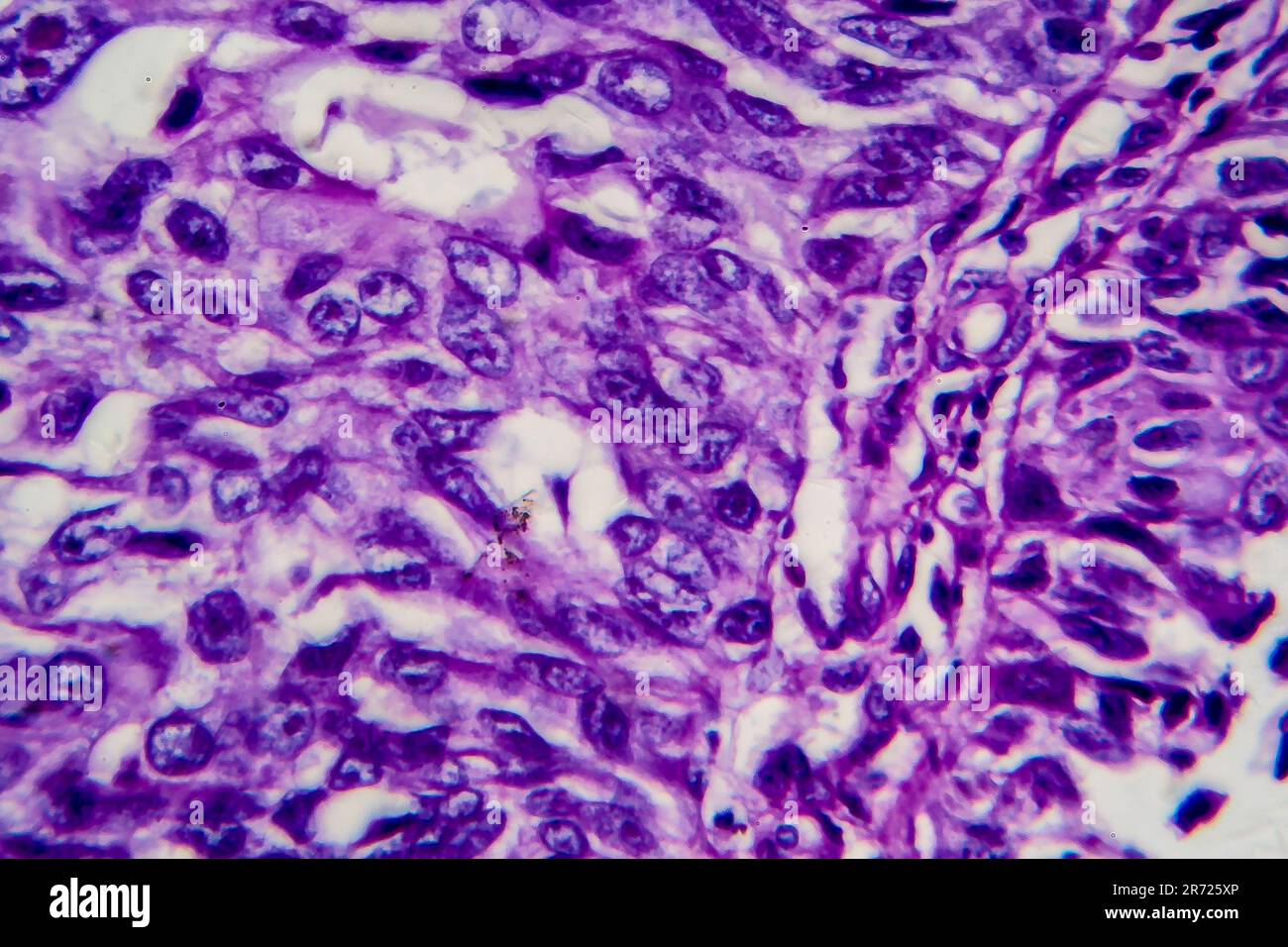 Bladder transitional cell carcinoma, light micrograph, photo under ...