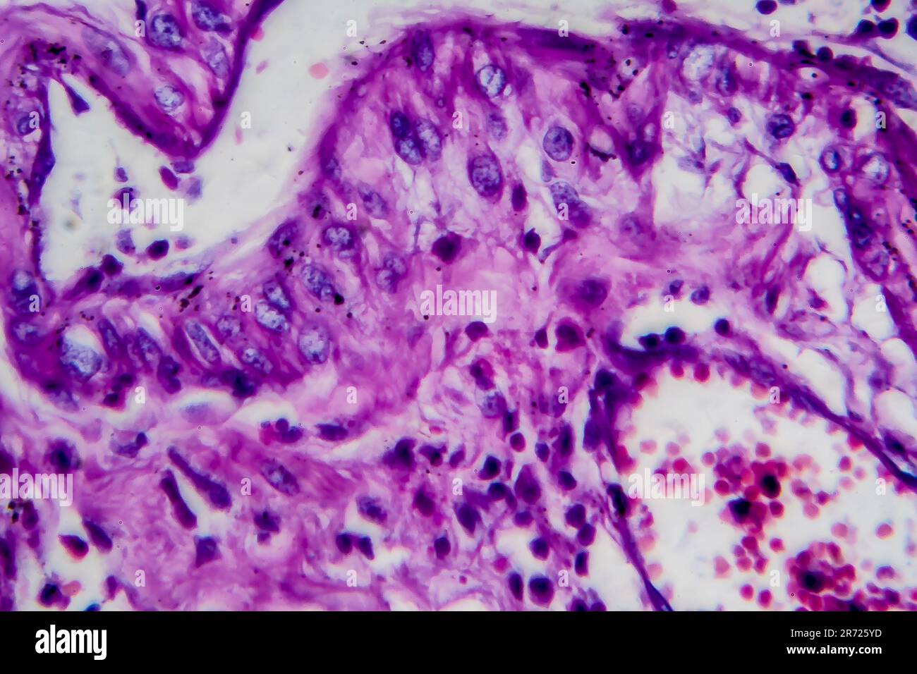 Bladder transitional cell carcinoma, light micrograph, photo under ...