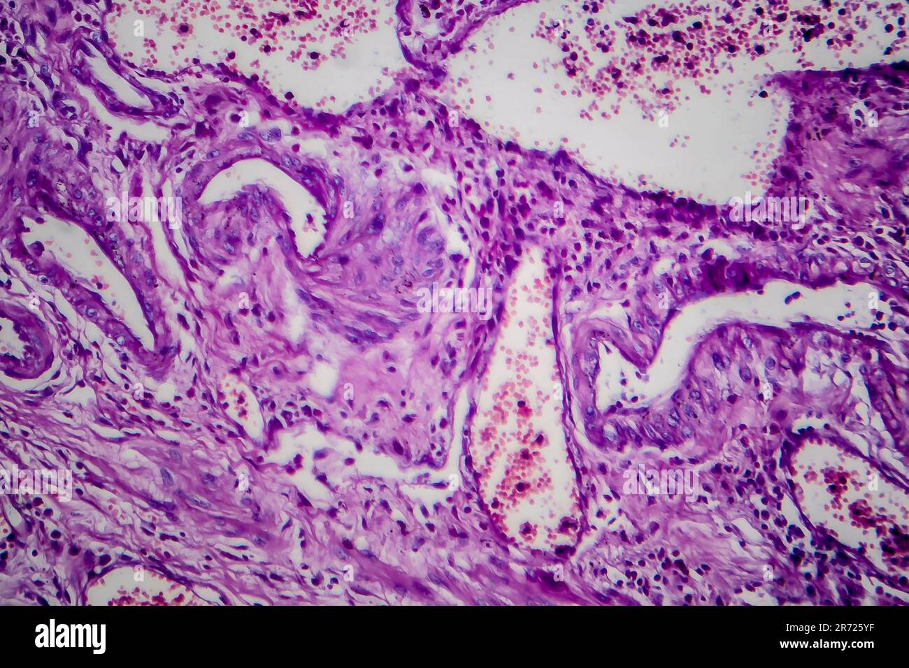 Bladder transitional cell carcinoma, light micrograph, photo under ...