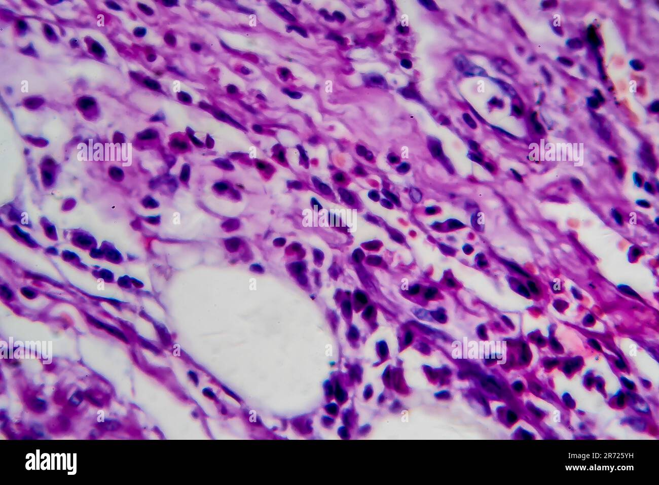 Bladder transitional cell carcinoma, light micrograph, photo under ...