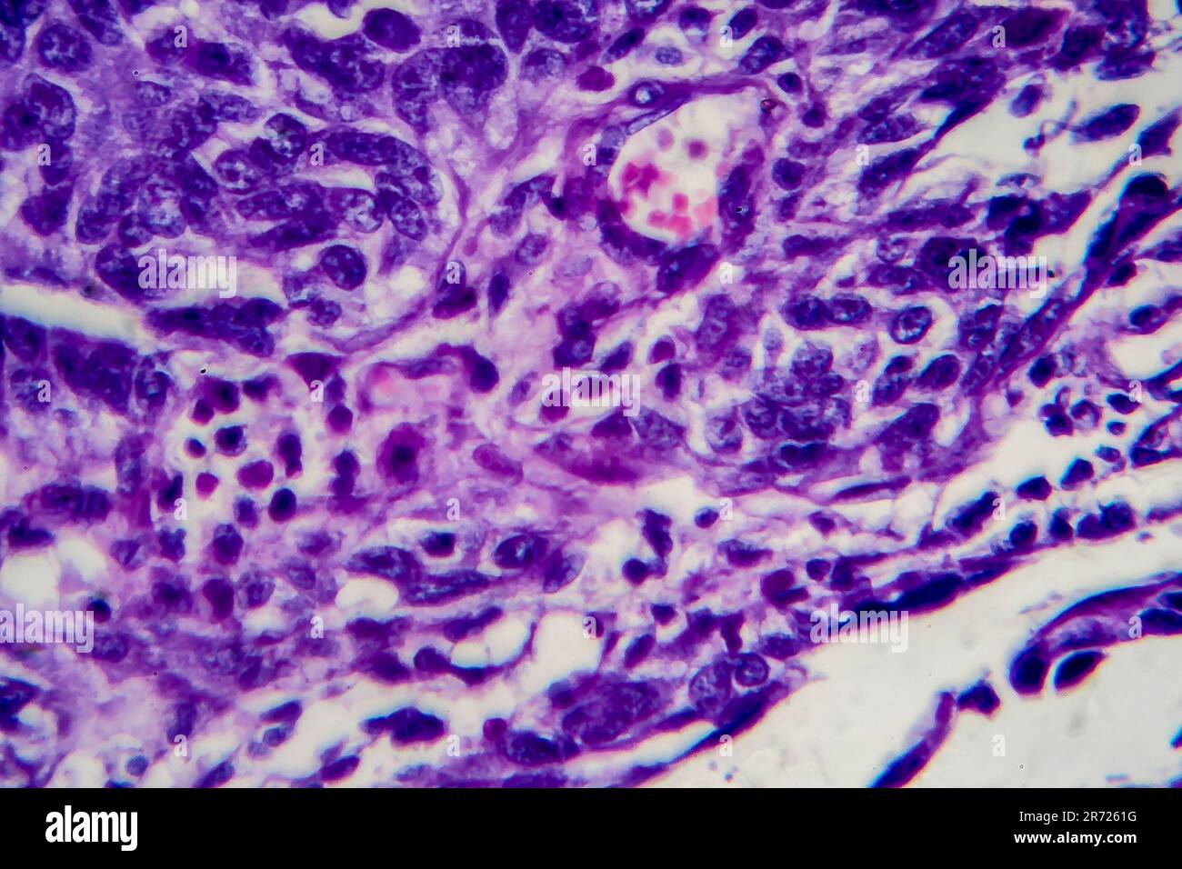 Neoplas hi-res stock photography and images - Alamy