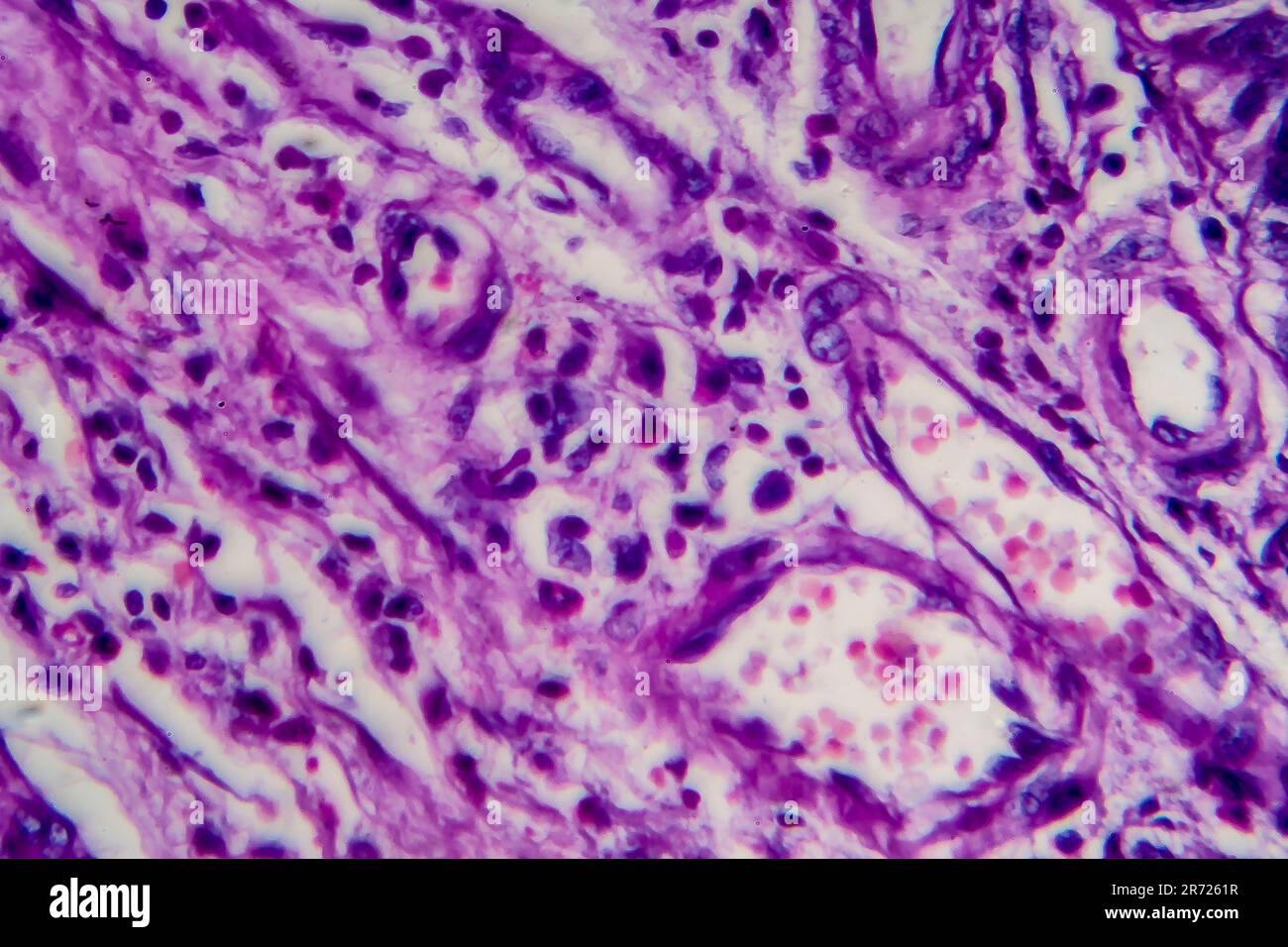 Bladder transitional cell carcinoma, light micrograph, photo under ...