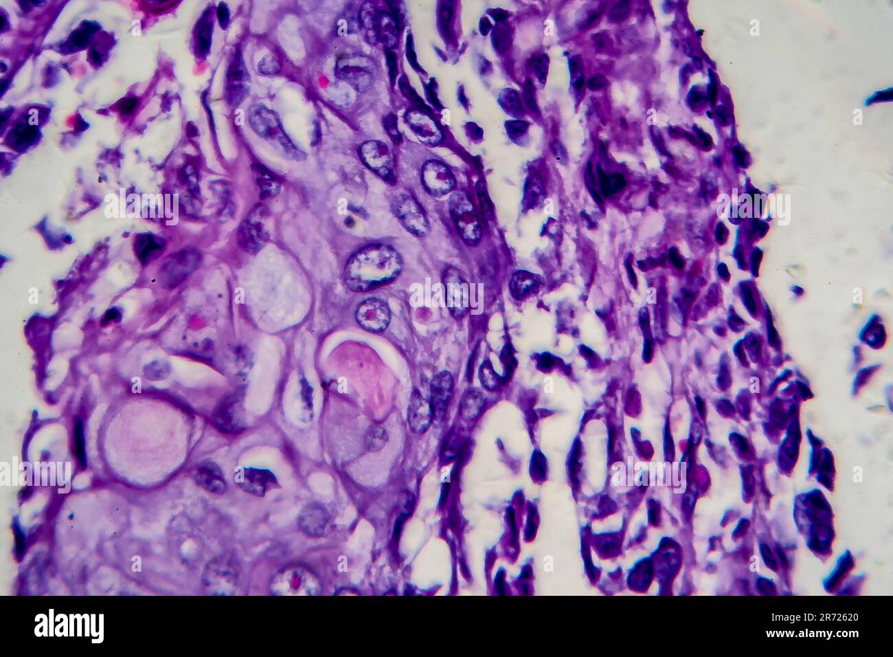 Bladder transitional cell carcinoma, light micrograph, photo under ...