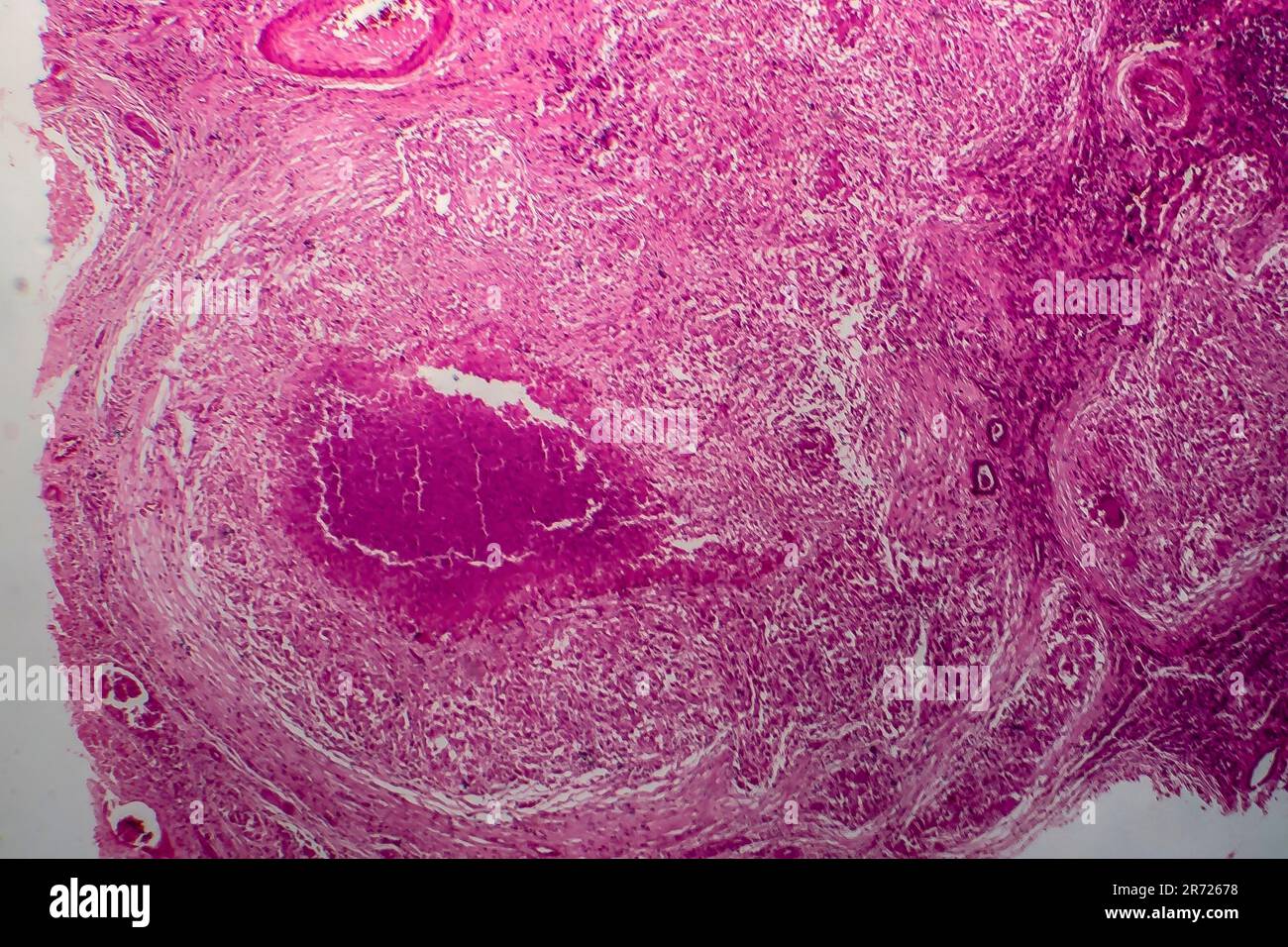Renal tuberculosis, light micrograph, photo under microscope Stock Photo - Alamy
