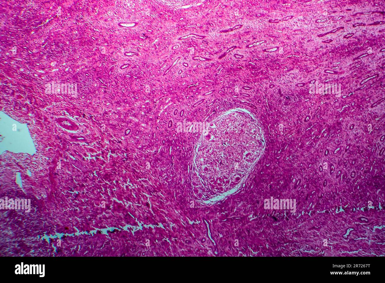 Renal tuberculosis, light micrograph, photo under microscope Stock ...